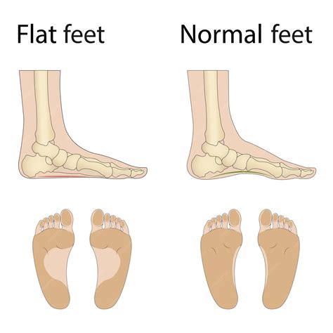 Premium Vector Foot Deformity Types Medical Disease Infographics