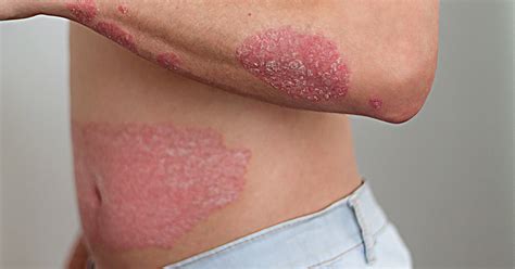 Difference Between Eczema And Psoriasis Do You Know The Difference