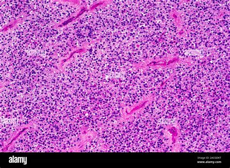 Nervous System Tumour Light Micrograph Of A Section Through A