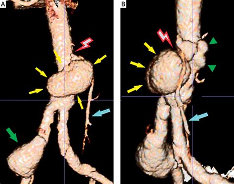 Spontaneous Avulsion Of The Inferior Mesenteric Artery In A