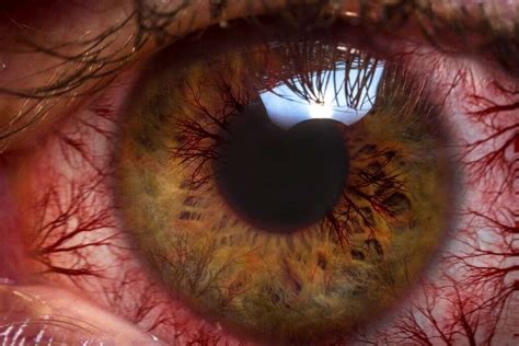 Corneal Ulcer Corneal Ulcer Symptoms