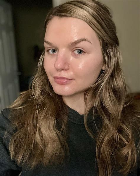 Before And After I Stopped Using Tretinoin Back On It Again 3 Dont