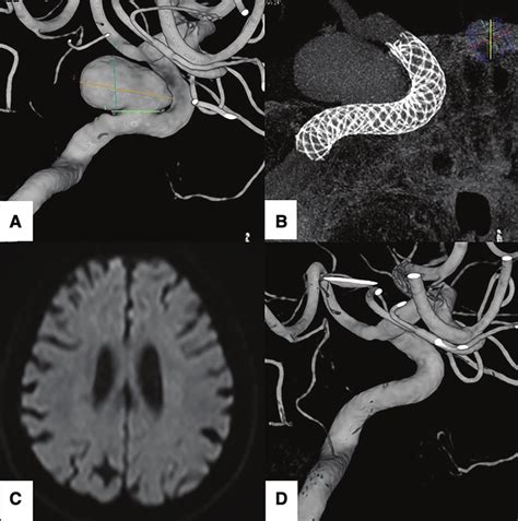 Perioperative Images And Angiographical Follow Up A A Pipeline Flex