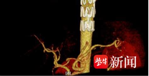 家门口拆弹南京鼓楼医院南部院区心脑血管病医院完成首例主动脉微创手术 腾讯新闻
