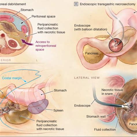 Video Assisted Retroperitoneal Debridement And Endoscopic Transgastric