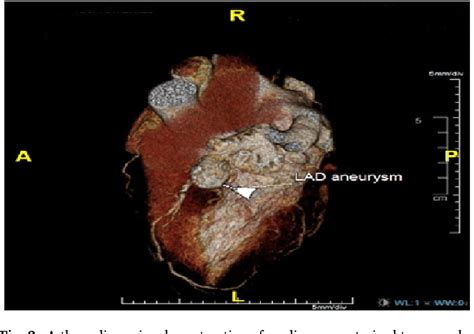 Figure 2 From Left Anterior Descending Artery Aneurysm In A Young