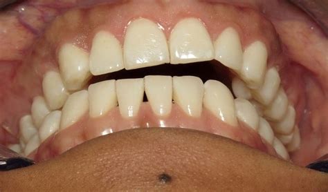 Maxillofacial Fibrous Dysplasia A Diagnostic Challenge Bmj Case Reports