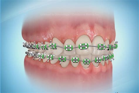 Colores De Brackets Bonitos Warehouse Of Ideas