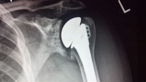 Arthroplasty Of The Shoulder Wheeless Textbook Of Orthopaedics