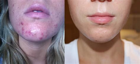 Microdermabrasion For Acne Scars Before And After Pics M3m