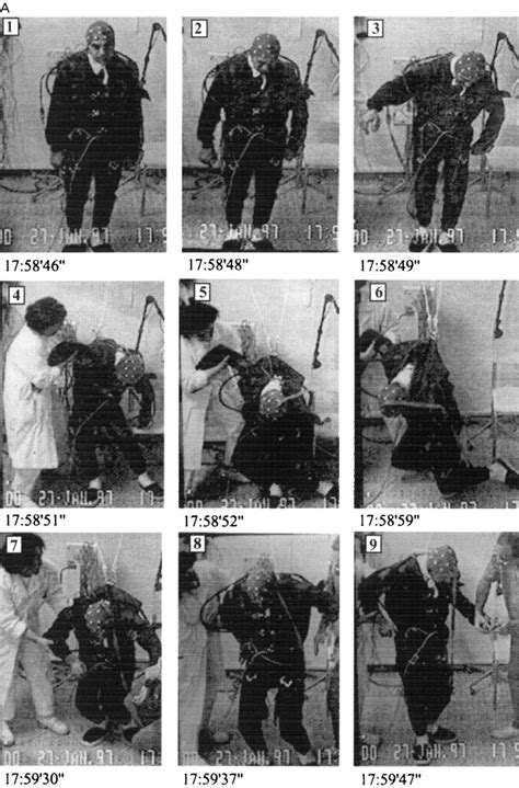 Epileptic Drop Attacks In Partial Epilepsy Clinical Features