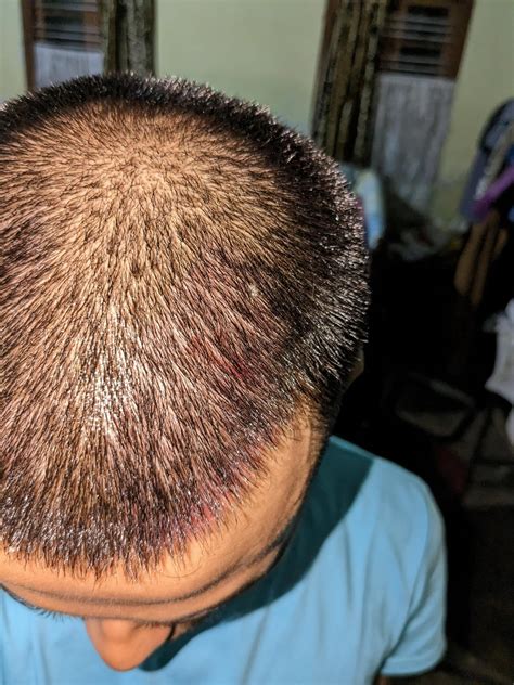 Psoriasis Or Seborrheic Dermatitis Rpsoriasis