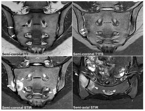 Sacroiliac Joint Pain Mri Radiologia Brasileira Sacroiliíte