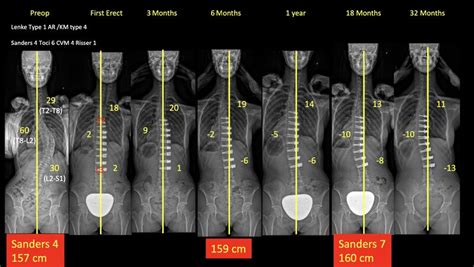 Prof Dr Ahmet Alanay On Linkedin Scoliosis Scoliosissurgery Vbt
