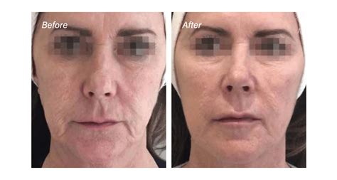 Profhilo Malaysia Most Popular Clinic Nextmed Clinic