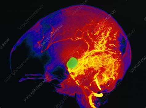 Coloured Angiogram Of Cerebral Aneurysm Stock Image M Science Photo Library