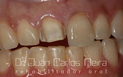 CASO Carillas En Disilicato De Litio Juan Carlos Neira Rehabilitador Oral