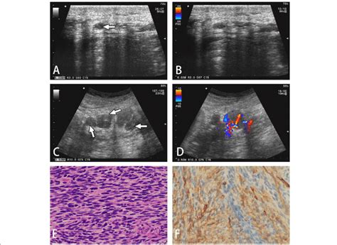 A 61 Year Old Man With Recurrent And Metastatic Dfsp A B An Ovoid