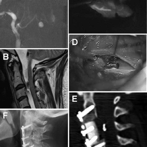 Right Supraclinoid Ica Blister Aneurysm Preprocedural Dsa A Shows A