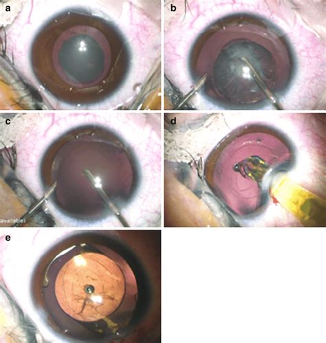 Anterior Lens Capsulotomy At Hope Whited Blog