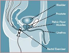 Treat Your Urinary Incontinence With Liberty Pelvic Floor Electrical Stimulation Therapy