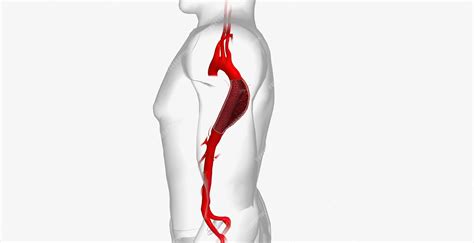Premium Photo Aortic Dissection Is A Serious Cardiovascular Condition