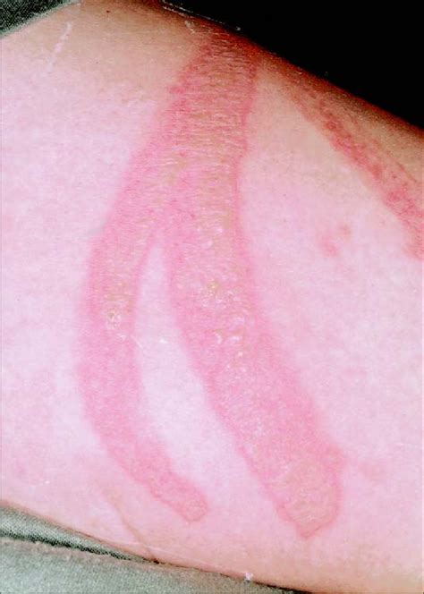 Linear Erythematous Vesicular Plaques With Hyperpigmentation On The Arm
