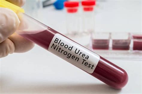 Urea Alta en Sangre Causas Síntomas Tratamiento