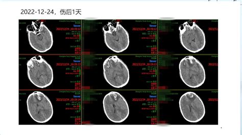 监测有道丨额叶脑挫裂伤救治：实施与反思——颅脑创伤 神经重症周刊（第330期） 脑医汇