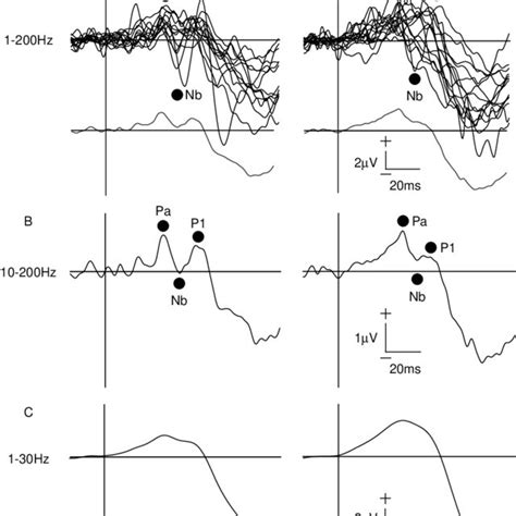 middle latency transient components and middle latency slow wave for