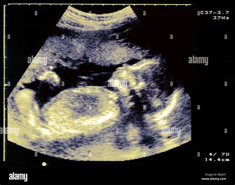 Ultrasound Fetus Hi Res Stock Photography And Images Alamy