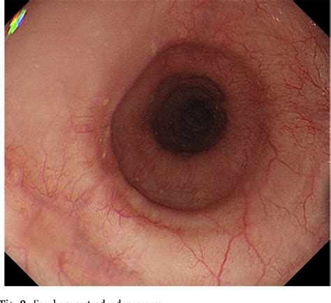 Figure 2 From Distal Oesophageal Spasm In A Patient With Multiple