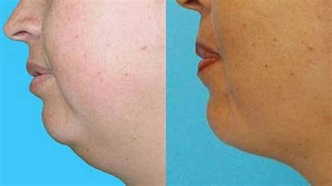 Eliminate Your Double Chin Without Surgery Step To Health