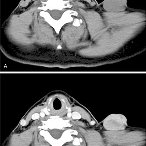 Left Supraclavicular Fossa Tumor A Well Defined Homogeneous