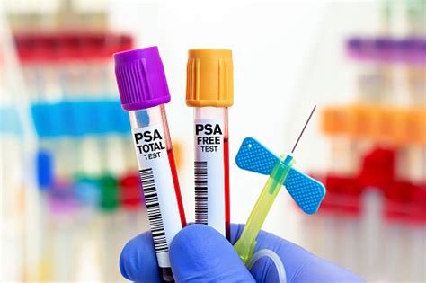 생화학 실험실에서 Psa 무료 및 Psa 총 검사를위한 혈액 튜브와 바늘을 가진 의사 전립선암에 대한 스톡 사진 및 기타 이미지