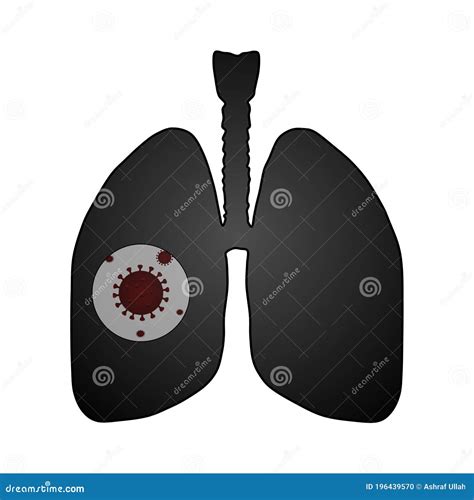 Pneumonia Illustration Shows Normal And Infected Alveoli