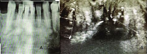Panoramic Radiograph A And Ultrasound Examination B Showing
