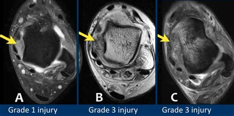 Anterior Tibiofibular Ligament Mri