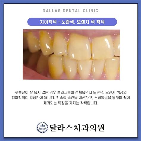 담배 니코틴 치아착색 어떻게 제거해야할까 아랫니 안쪽 착색제거 양산덕계치과 달라스양산치과 Youtube