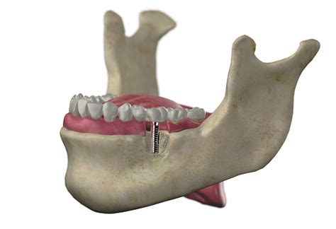 아래 치아와 턱 골격 대각선 보기 3d 렌더링에 치과 임플란트 치아 임플란트에 대한 스톡 사진 및 기타 이미지 치아 임플란트