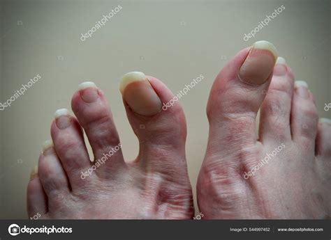 Long Ugly Toenails