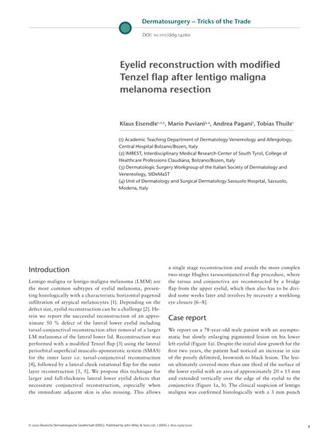 Pdf Eyelid Reconstruction With Modified Tenzel Flap After Lentigo Maligna Melanoma Resection