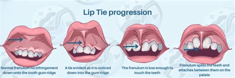 Upper Lip Tie In Adults What It Is How It Affects You And What You