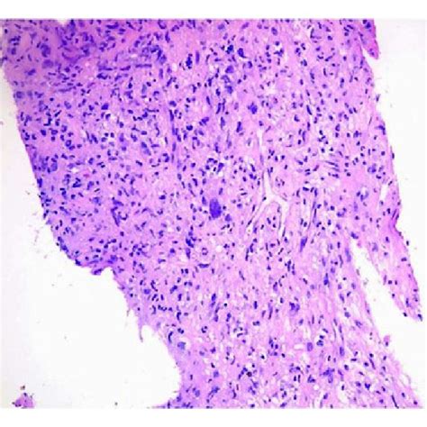 Hematoxylin Eosin Stain Showing A Poorly Differentiated Sarcoma With Download Scientific
