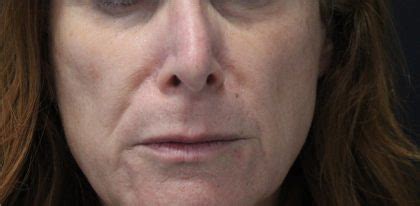 Patient Liquid Facelift Before And After Photos Santa Monica