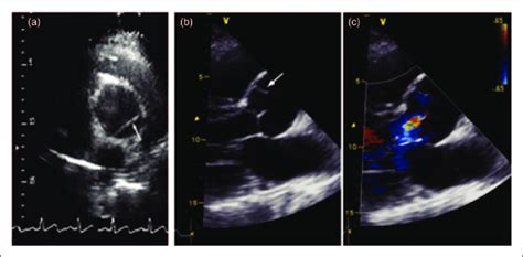 Transthoracic Echocardiogram Showing A Type A Aortic Dissection A B
