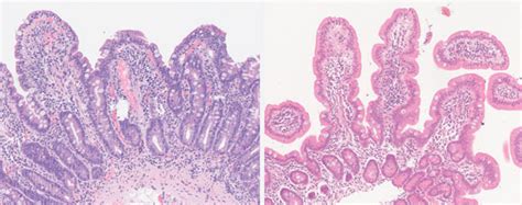 Cyclospora Infection Masquerading As Coeliac Disease The Medical Journal Of Australia