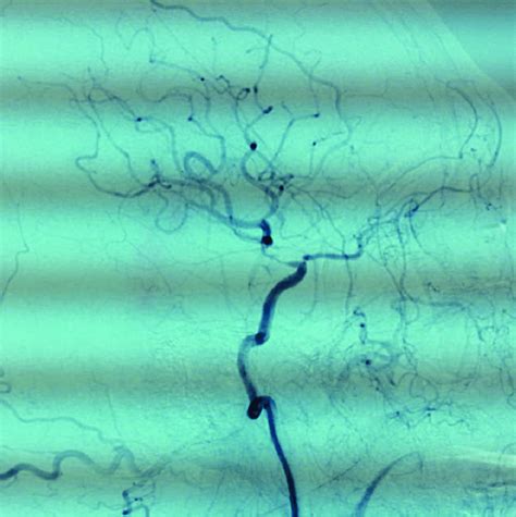 Dsa Showed Stenosis Of Right Ica Dsa Digital Subtraction