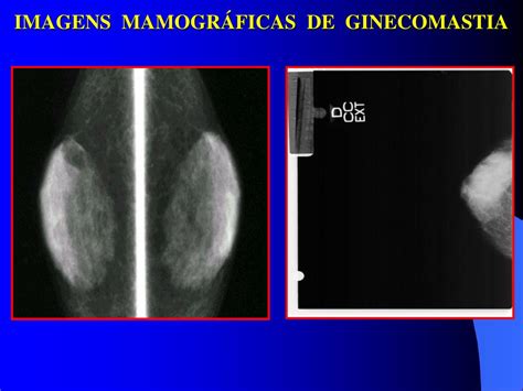 Ppt Ginecomastia Powerpoint Presentation Free Download Id 6995272