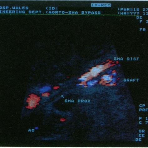 Duplex Colour Flow Scan Showing Sma Stenosis 90 Figure 4 Duplex